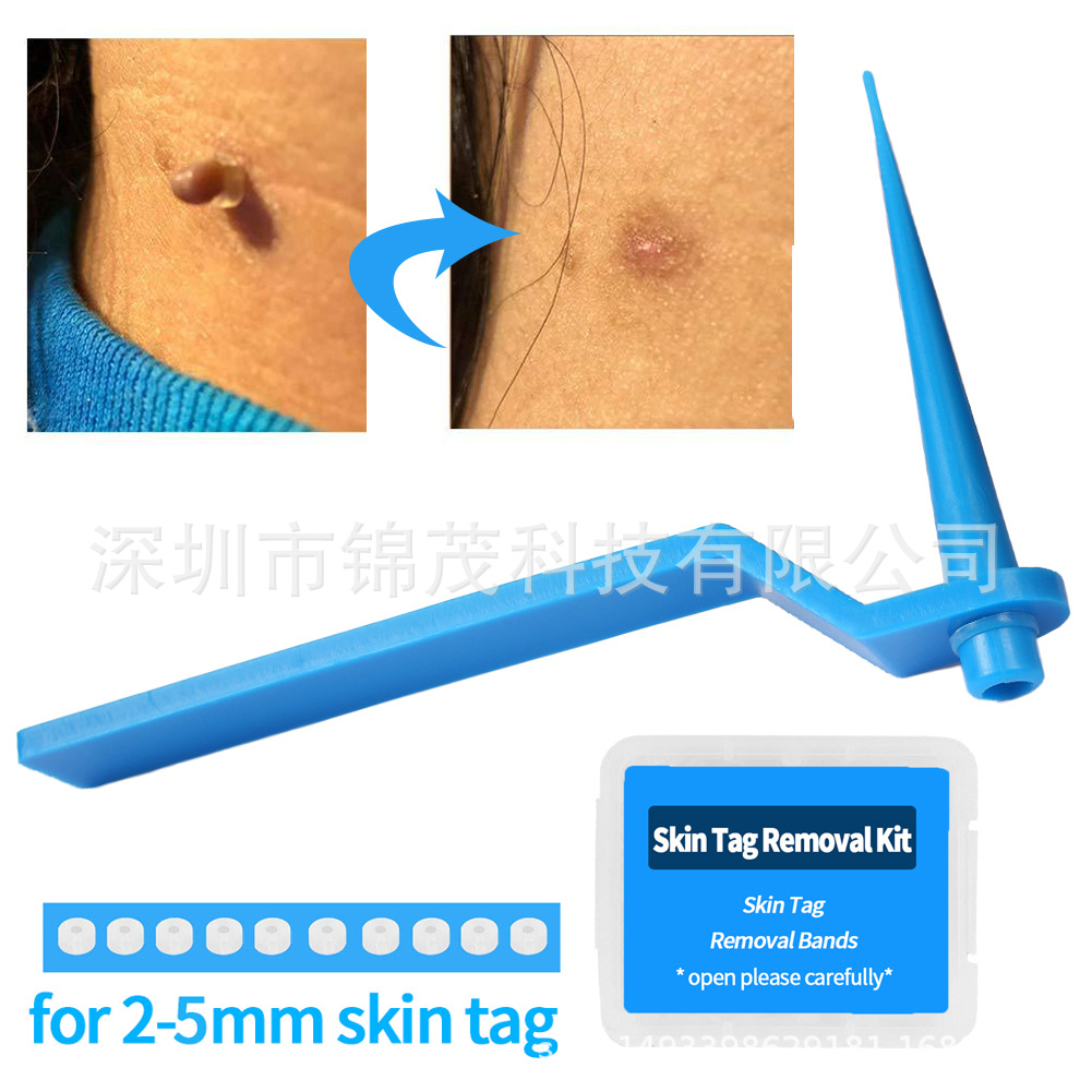 Skin Tag rubber Band Removal 肉粒祛肉痣皮赘器肉猴疣-阿里巴巴