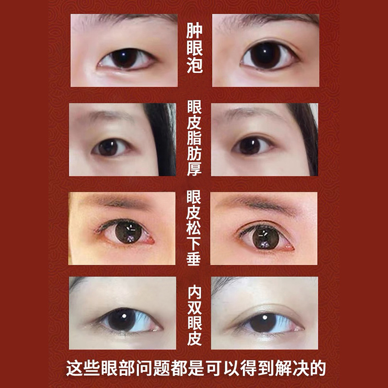 Baicao Shijia Swelling Eye Follicles, Removing Fat, Removing Bags ...