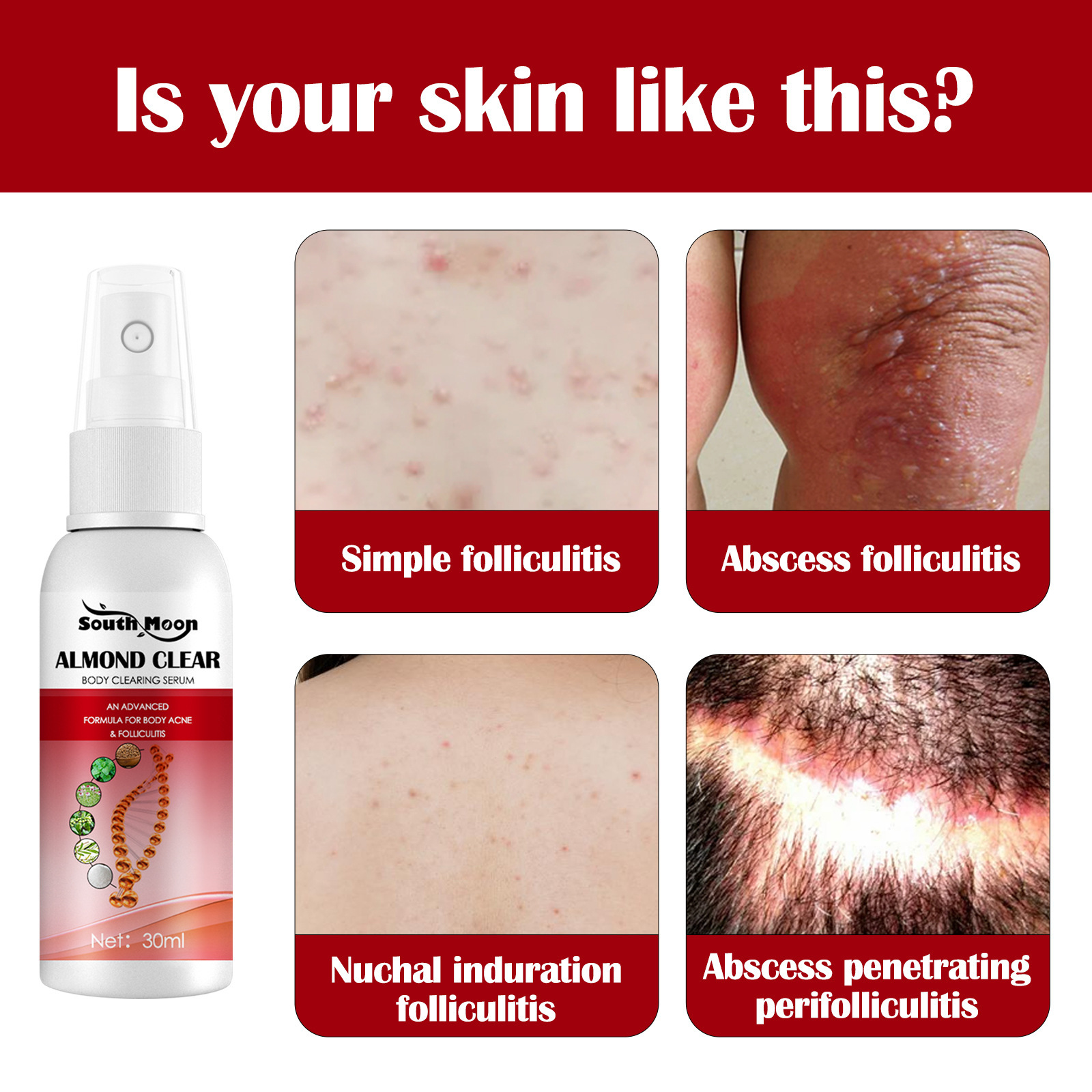 South Moon Spray Dermatitis Treatment Eczema Removal Skin Cr-阿里巴巴