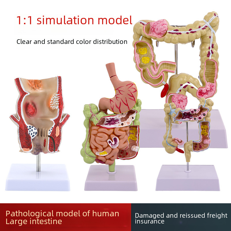 Large intestine pathological model gastrointestinal model large ...