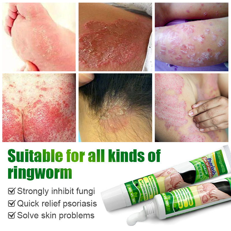 KanyeHB Psoriasis Bacteriostasis Cream 皮肤护理乳膏 外贸ebay-阿里巴巴