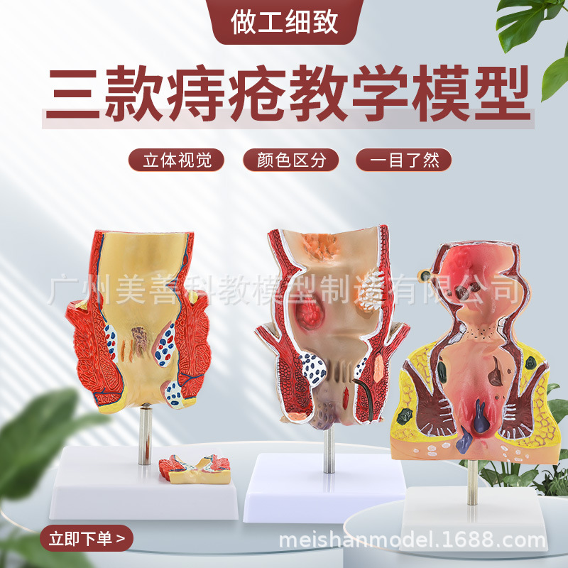 Rectal Hemorrhoids Large Intestine And Colon Lesion Model Internal And