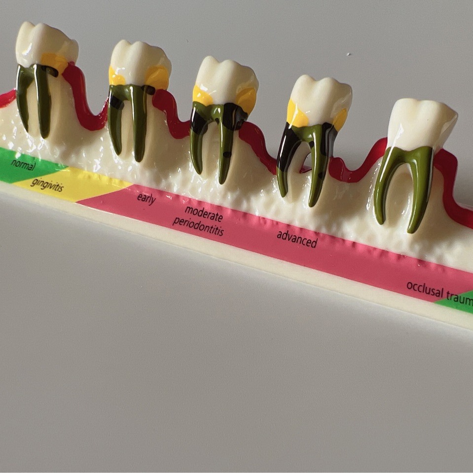Dental Model for Demonstrating the Progression of Periodontal Disease ...