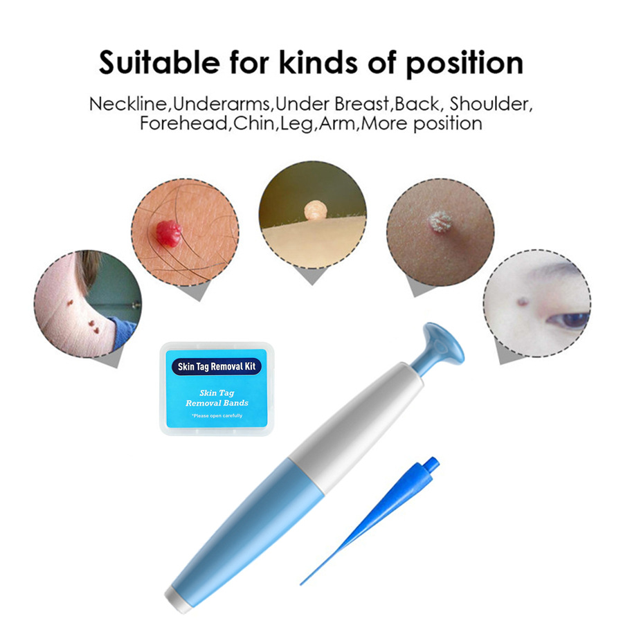Skin Tag Removal Tool祛疣工具祛皮赘笔祛肉痣祛祛鸡眼祛疣器-阿里巴巴