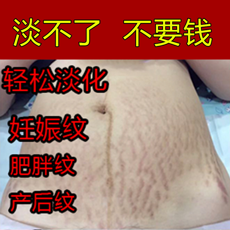 Stretch Mark Repair Cream, Postpartum Removal of Pregnancy Marks ...